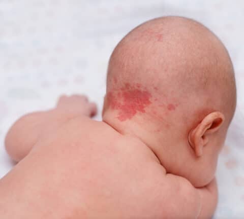 A Parent’s Guide to Port-Wine Birthmarks | Causes, Treatment & Expert Care