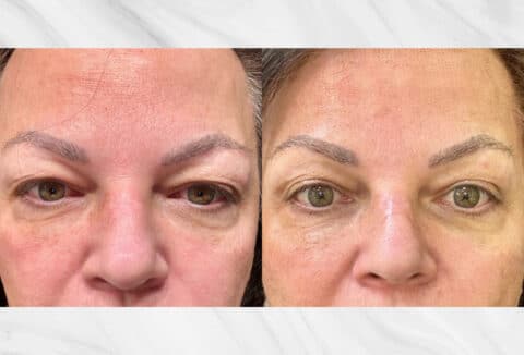 AVAVA Miria Laser Treatment in New York City | Roy Geronemus, MD